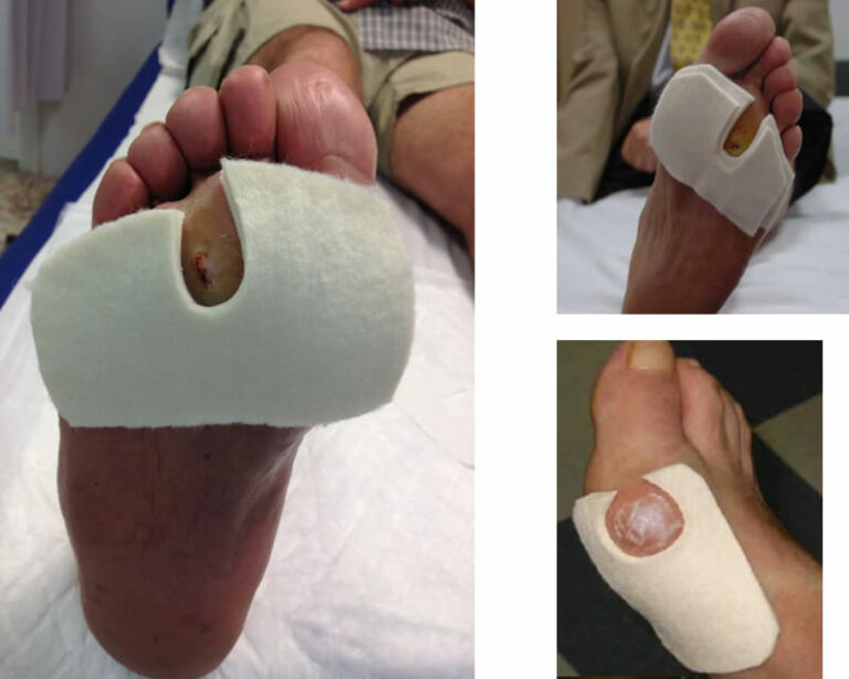 Cómo identificar y tratar las úlceras más habituales